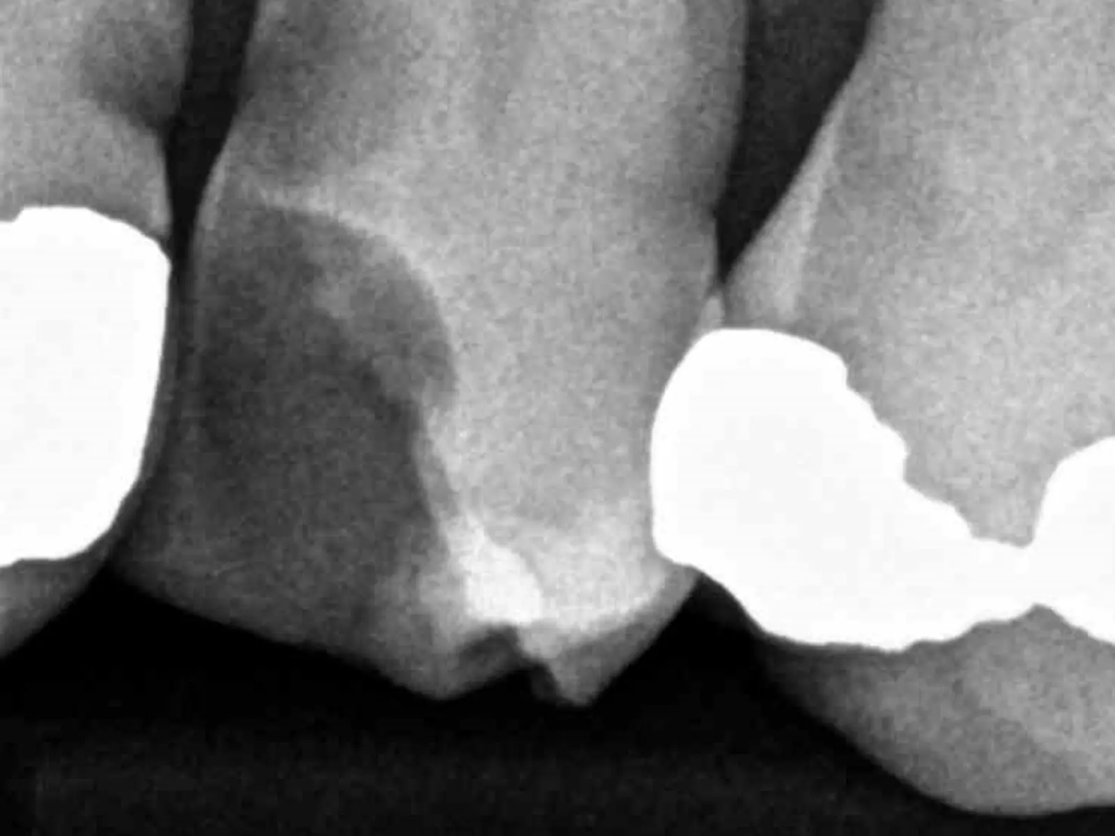 Root Canal Therapy | Durango Dental