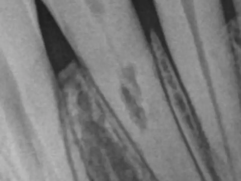 Root Canal Therapy | Durango Dental
